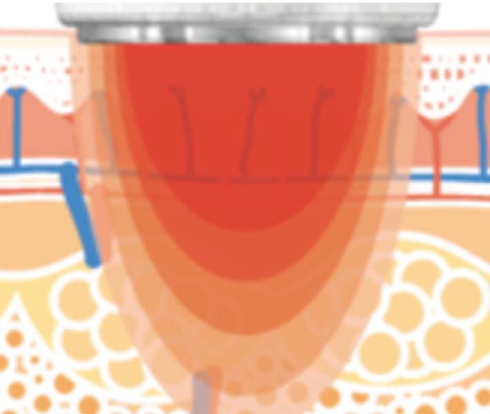 POWERSHAPE 2 - Cellulite Reduction & Skin Tightening Machine