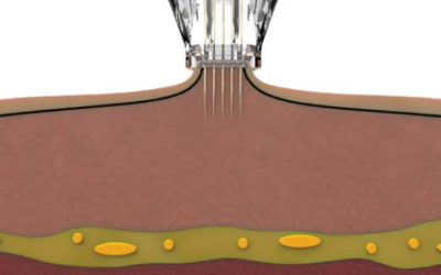 FOCUSDUAL - HIFU Skin Tightening Machine - CliniMed Aesthetics