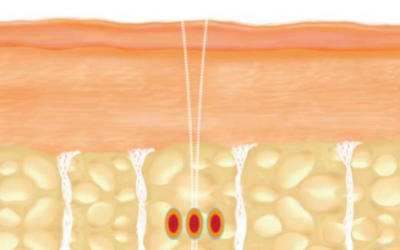 FOCUSDUAL - HIFU Skin Tightening Machine - CliniMed Aesthetics